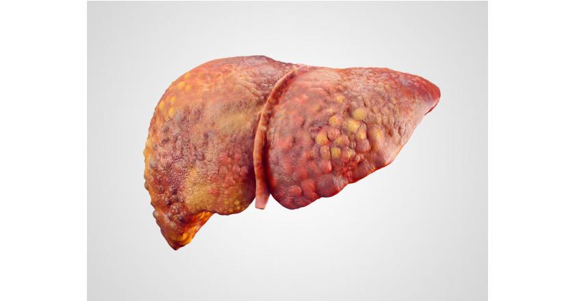 Marskość wątroby – objawy, przyczyny, leczenie - Zielarz-Dietetyk.pl